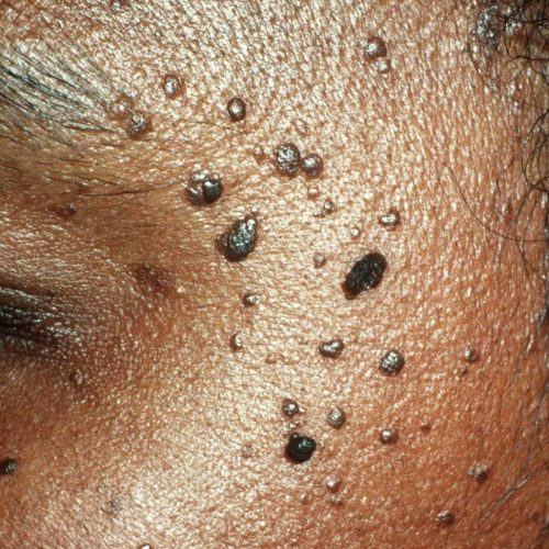 Seborrheic Keratosis - DPN - Alexandria, LA - Cenla Dermatology