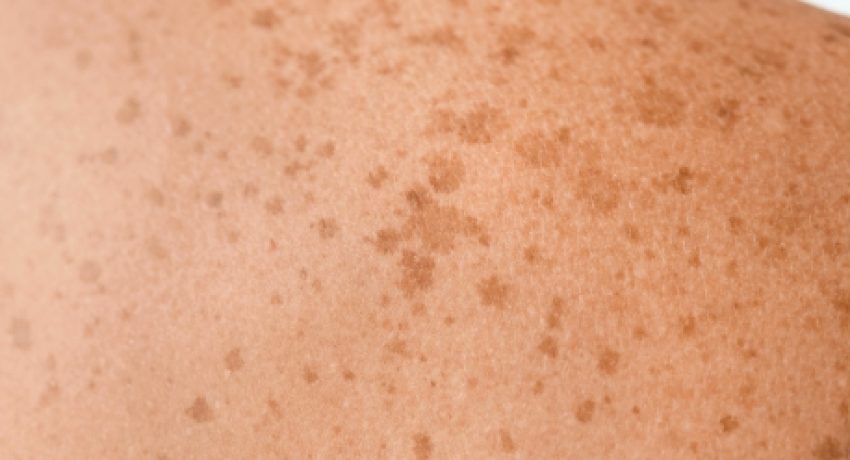 Understanding the treatment options for sunspots.